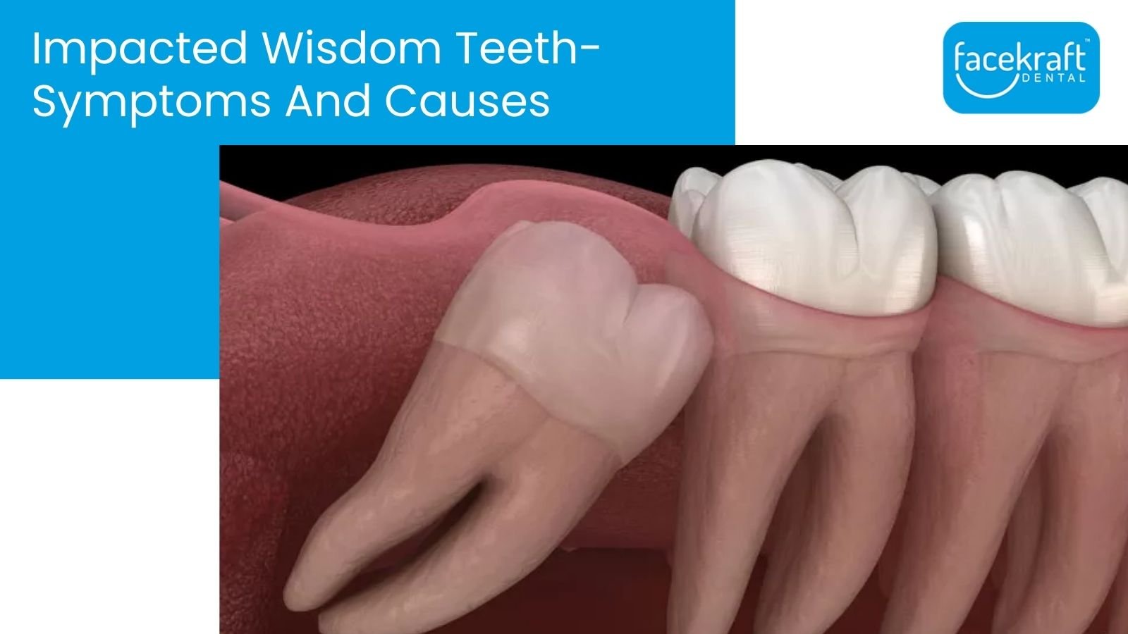Impacted Wisdom Teeth - Symptoms And Causes - Face Kraft Clinic